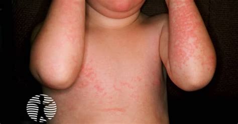 Erythema Infectiosum Image