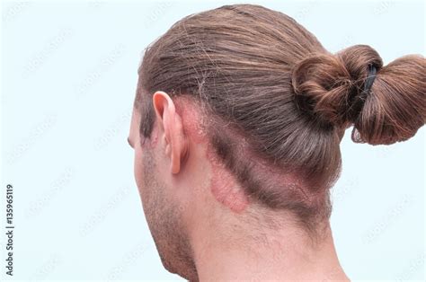 Eczema On Back Of Neck