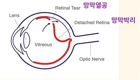 망막열공박리 강남연세안과