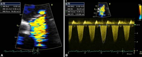 A B Severe Mitral Regurgitation—the Quantitative Assessment By