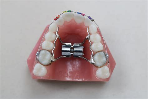Palatal Expander Village Orthodontics And Minneapolis Orthodontics Minneapolis New Brighton Mn