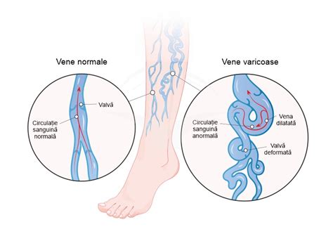 Varicele Factori Predispozanti Diagnostic Si Tratament