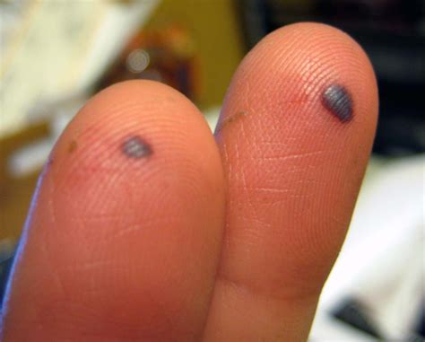 Blood Blister On Scrotum Causes Angiokeratoma Pictures Treatment