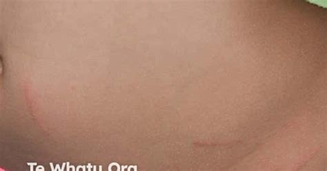 Plant Dermatitis Image Plant Dermatitis Image