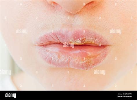 Close Up Of Girl Lips Affected By Herpes Treatment Of Herpes Infection