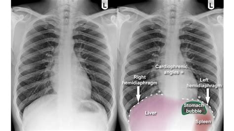 Chest X Ray Cxr Interpretation Made Easy A Comprehensive Guide To