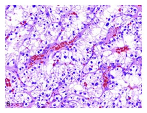 A Showing Solid Variant Of Clear Cell Adenocarcinoma Of The Bladder