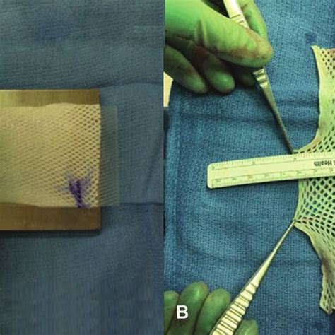 Meshed Acellular Dermal Matrix Adm Used In Breast Reconstruction A