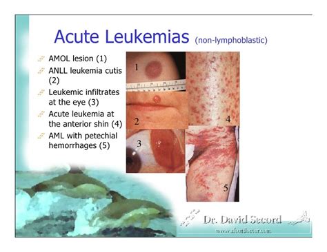 Petechiae Leukemia Symptoms