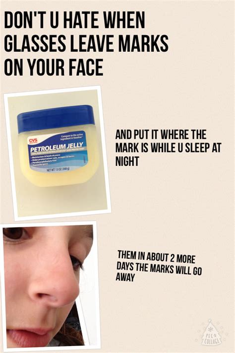 How To Get Rid Of Spectacle Marks On Your Nose Naturally Artofit