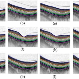 Twelve B Scan Segmentation Results From An Example D Segmented