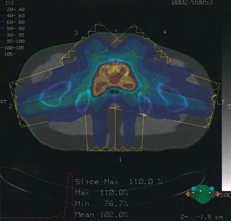 Intensity Modulated Radiation Therapy Radiology Key