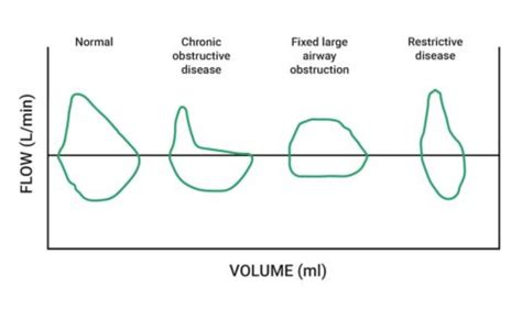 5 Pulmonary Function Testing PFT Tips For The TMC Exam