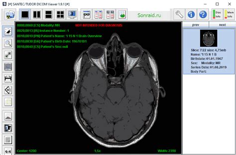 Tudor Dicom Viewer 191 программное обеспечение для работы с Dicom