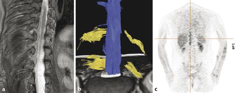 Diffusion Weighted Imaging And Diffusion Tensor Imaging In Spine And