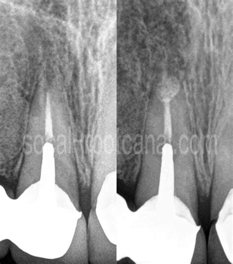 Apicoectomy And Retrograde Filling Socal Root Canal