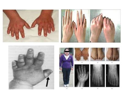 Pseudohypoparathyroidism For Mrcpch Clinical