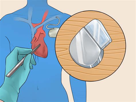How To Treat Tachycardia 10 Steps With Pictures Wikihow