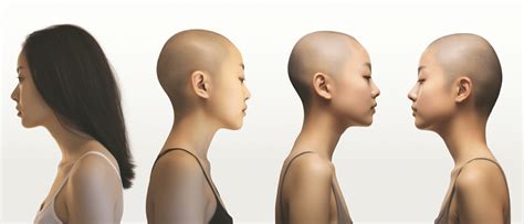 Dealing With Hair Loss During Cancer Treatment