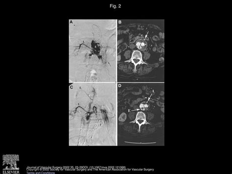 Treatment Of Type 2 Endoleaks After Endovascular Repair Of Abdominal