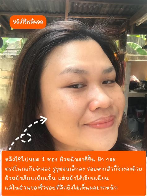 เรตินอลหลักสิบ แกลเลอรีที่โพสต์โดย รีวิวแล้วแต่ใจ Lemon8