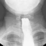 Difference Between Tag Archive For Achalasia Achalasia