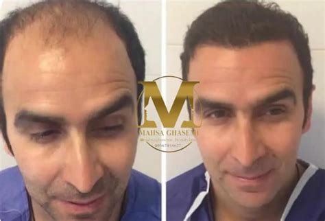 خدمات کاشت مو مهسا قاسمی در شیراز ایران مشاغل