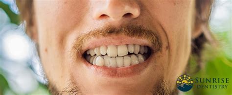 6 Types Of Occlusion Sunrise Dentistry