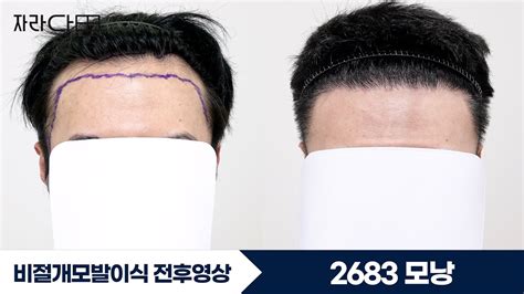 2683모낭 대량이식 M자 헤어라인 자라다의원 Youtube