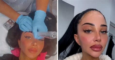 Watch Tulisa Contostavlos Shows Off Dramatic Cosmetic Procedure Before