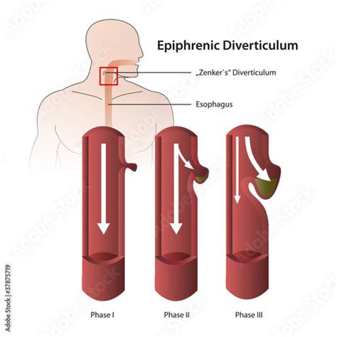 Diverticulum Epiphrenic Eps Vector Illustration Stock Image And