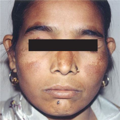 Pigment Disorders And Vascular Abnormalities Flashcards Quizlet