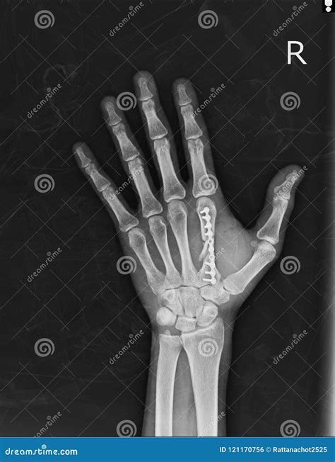 Fracture Of Leg With Post Op Fixation Royalty Free Stock Photography