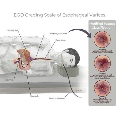 Kania Indriani Rosep Putri On Linkedin Egd Grading Of Esophageal