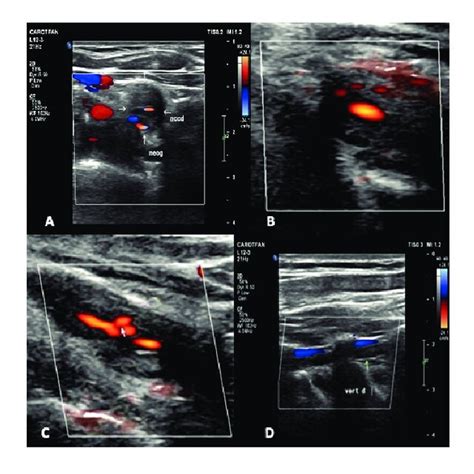 A Transverse Section Of The Right Common Carotid Artery With Color