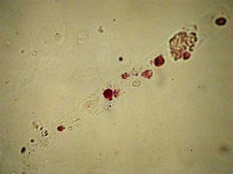 Wbc Casts In Urine
