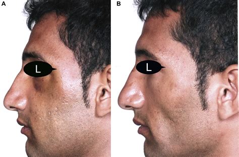 Buccal Fat Pad Lifting An Alternative Open Technique For Malar