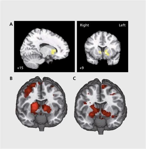 Striatal Dopamine Reward And Decision Making In Schizophrenia Pmc