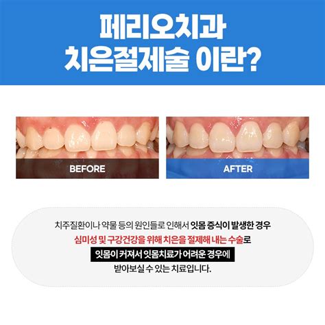 페리오치과 치은절제술에 대해 들어보셨나요 이는 치주질환이나 약물 등 다양한 원인들로 인해서 잇몸