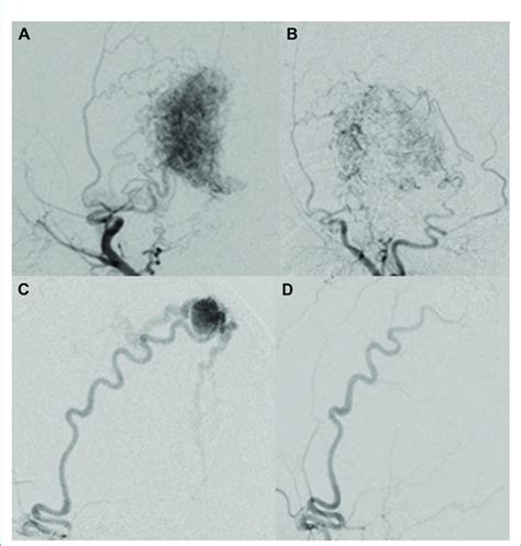 A Angiogram Showing Plexiform Type Of Scalp Arteriovenous Download Scientific Diagram