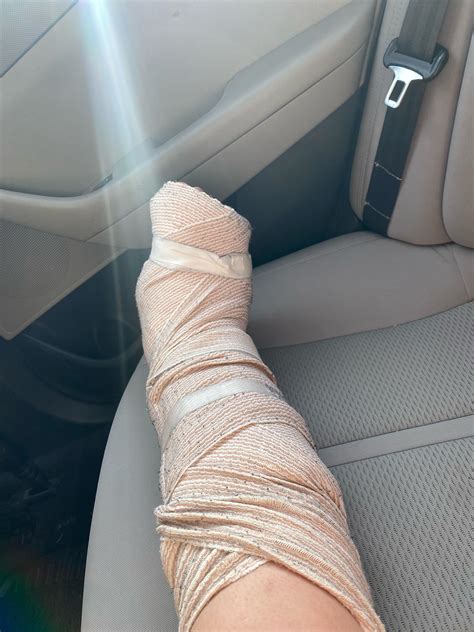 Cast Vs Splint Opinions Rbrokenbones