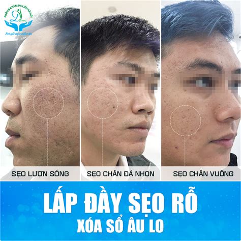Cách Trị Sẹo Rỗ Lâu Năm Trên Mặt Tốt Nhất Phòng Khám Da Liễu Hà Nội