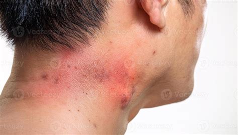 Detailed Shot Of Allergic Contact Dermatitis On The Neck Showing Redness Inflammation And