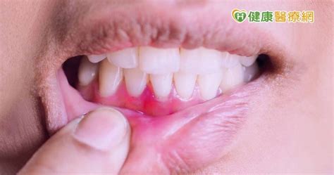 Preventing Gum Recession Effective Toothbrushing Techniques And