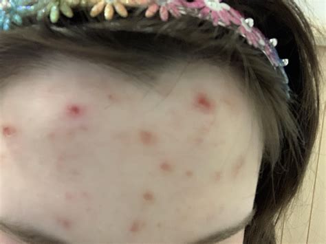 Unresolved Skin Issue Rdermatologyquestions