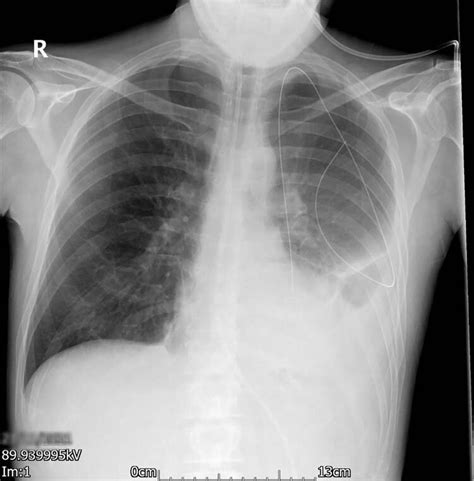 Posterior Anterior Chest Radiograph After Chest Drain Insertion Showing
