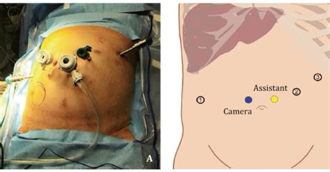 Robotic Assisted Placement Of Hepatic Artery Infusion Pump For The