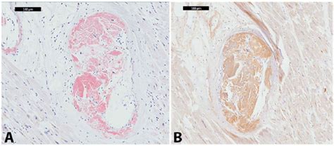 Photomicrograph Of The Heart Showing Coronary Artery Deposition Of