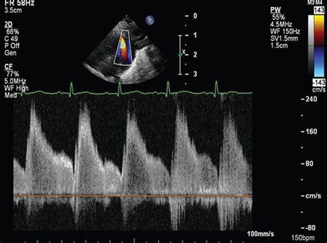 Patent Ductus Arteriosus And Aortopulmonary Window Thoracic Key