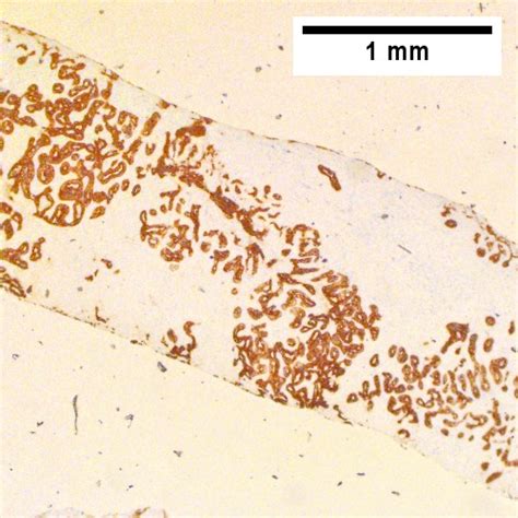 Cholangiocarcinoma Libre Pathology